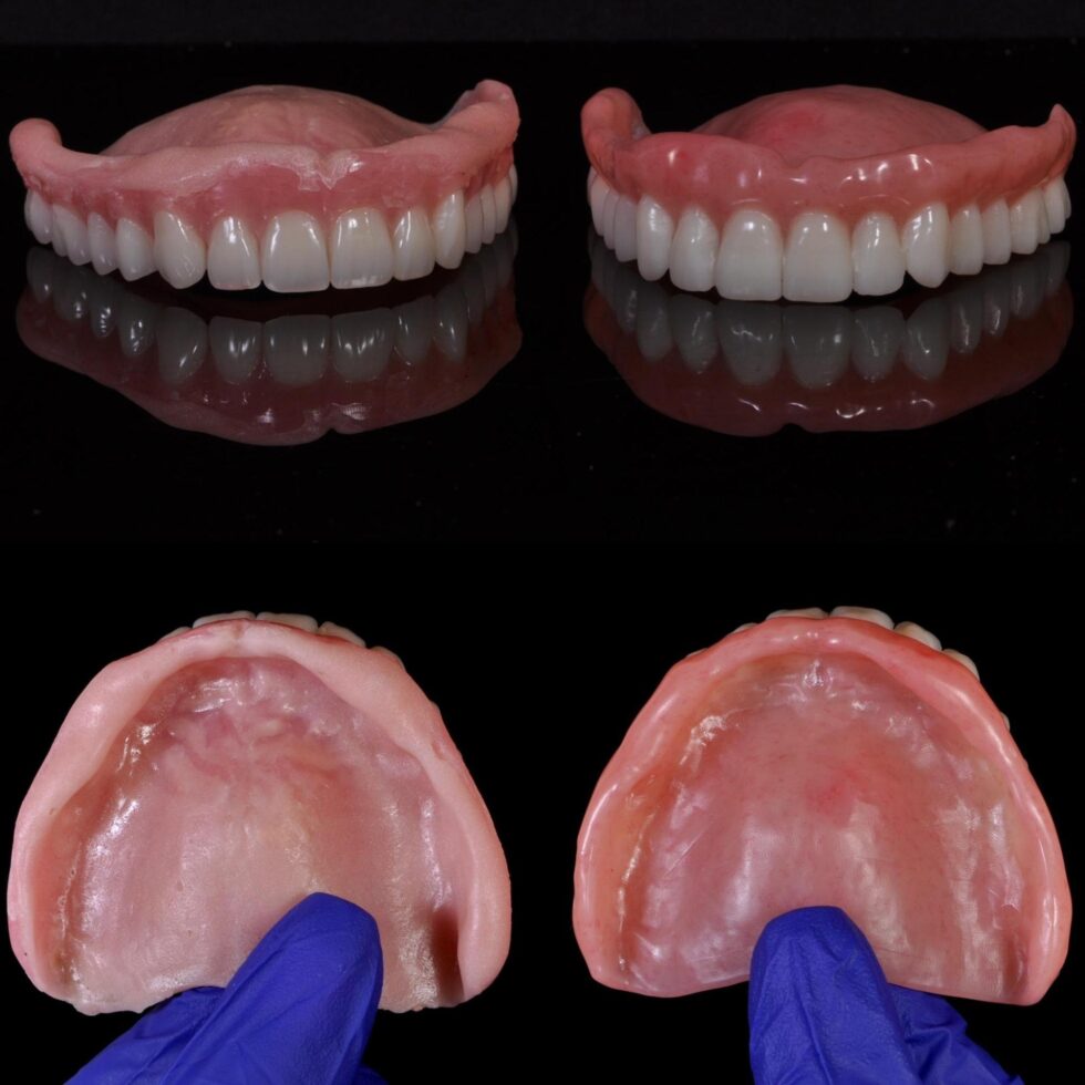 Premium Digital Dentures | Perfect Smile - 2025