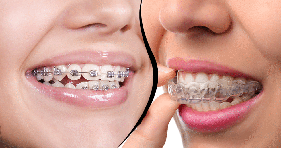 Invisalign vs Braces: The Ultimate Guide to Choosing the Best Orthodontic Treatment in Vancouver